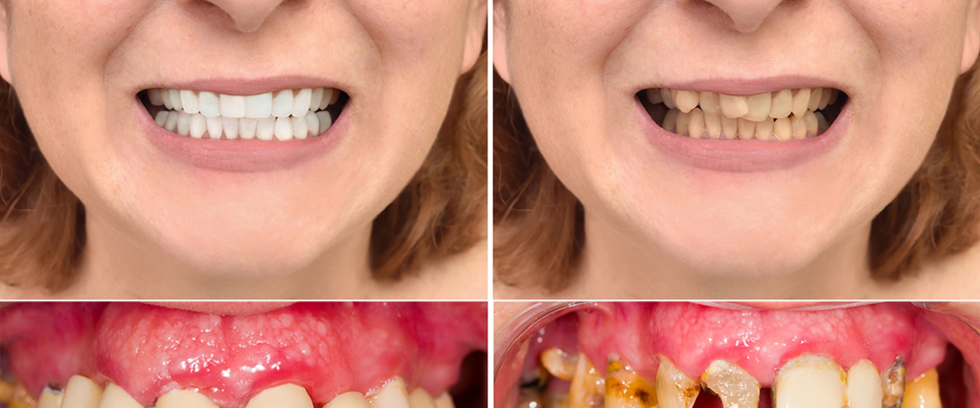 What options are there for perfect teeth?