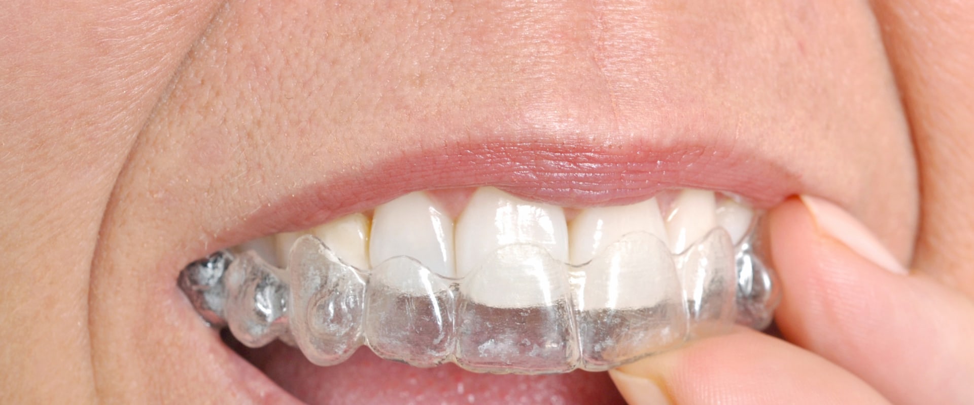 Invisalign In Spring, TX: Your Guide To Straightening Your Teeth With ...