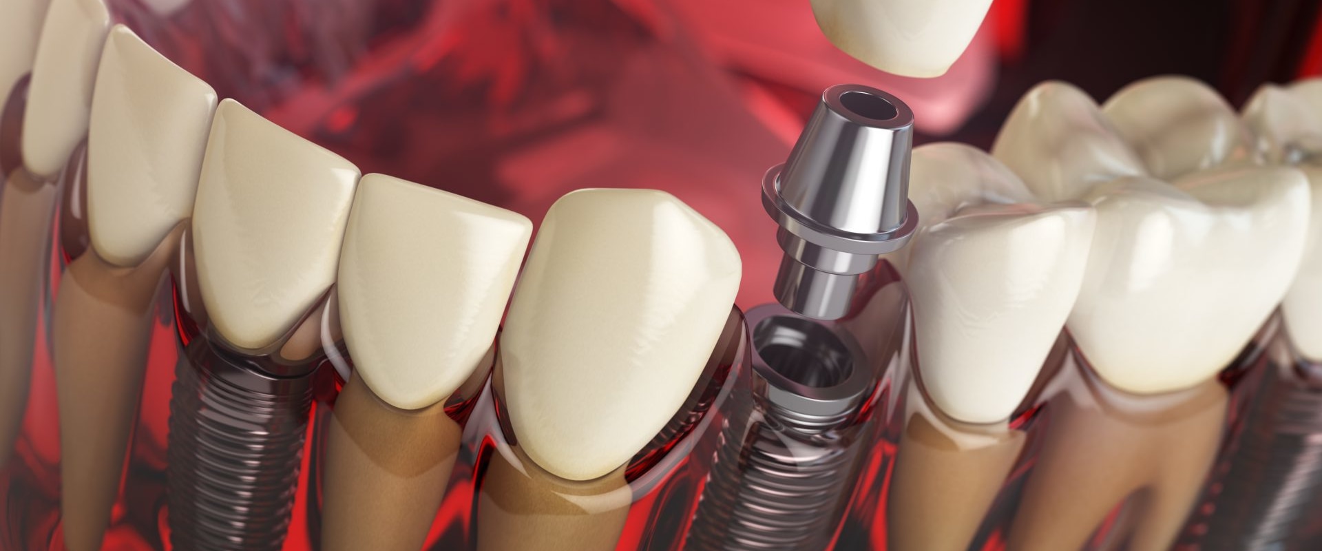 Cosmetic Dentistry In Spring Branch: A Comprehensive Guide To Dental ...