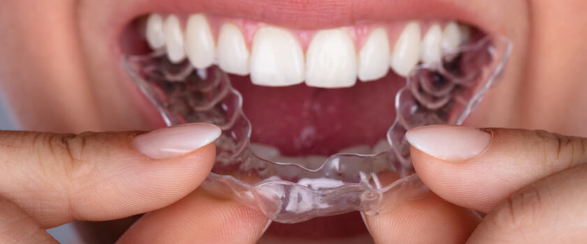 Perfecting Your Smile In North Las Vegas: Orthodontics As The Finishing ...